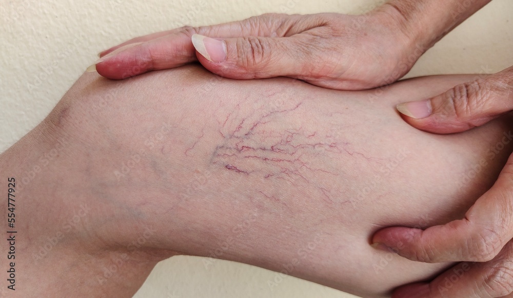 portrait showing the hands holding the varicose spider veins on the leg ...