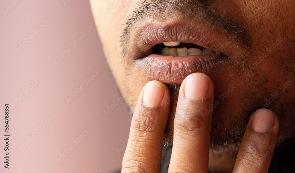 Dry lips problem Stock Photo | Adobe Stock
