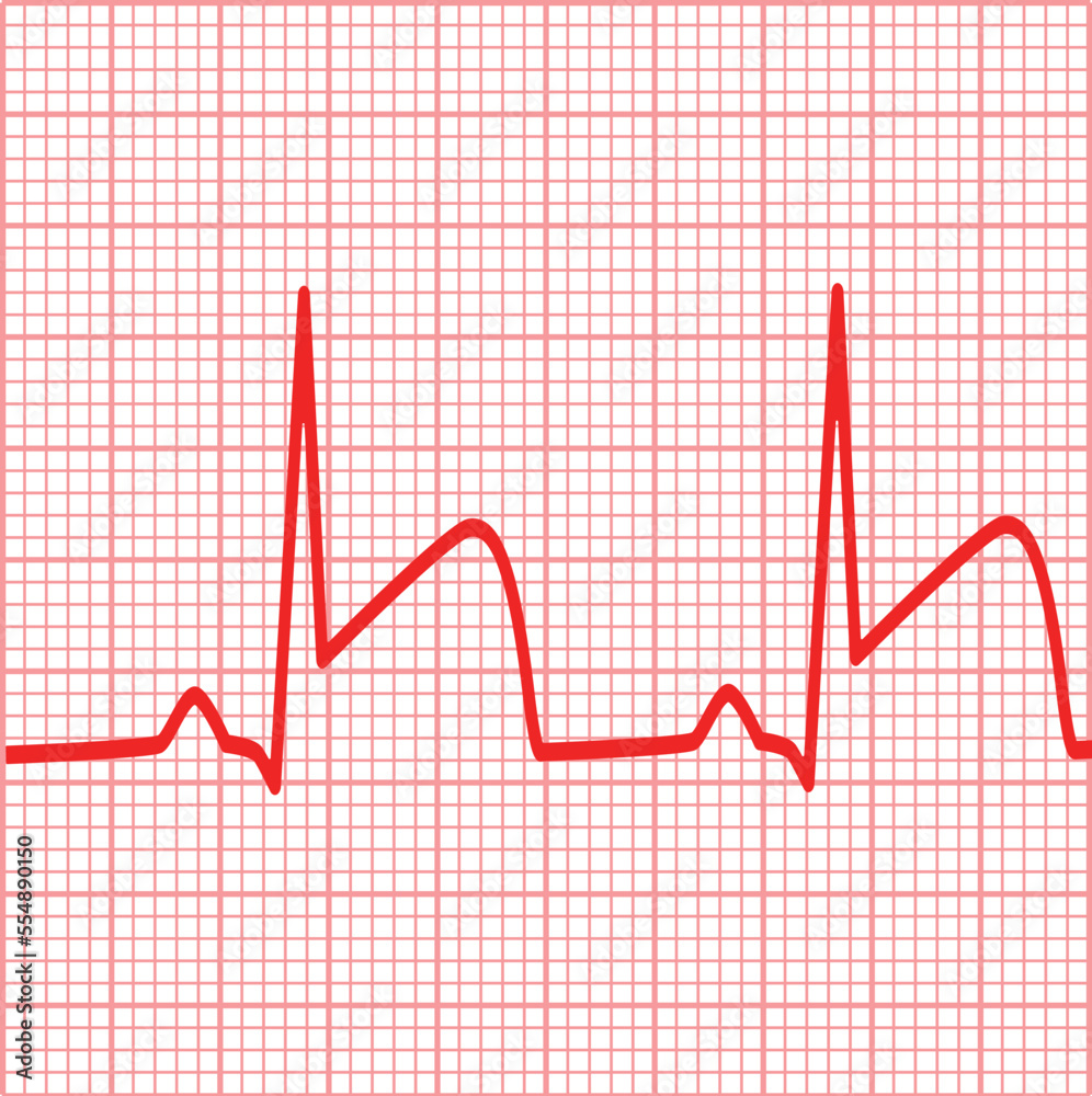 depicts ECGs for myocardial infarction. Heart attack sign. coronary ...