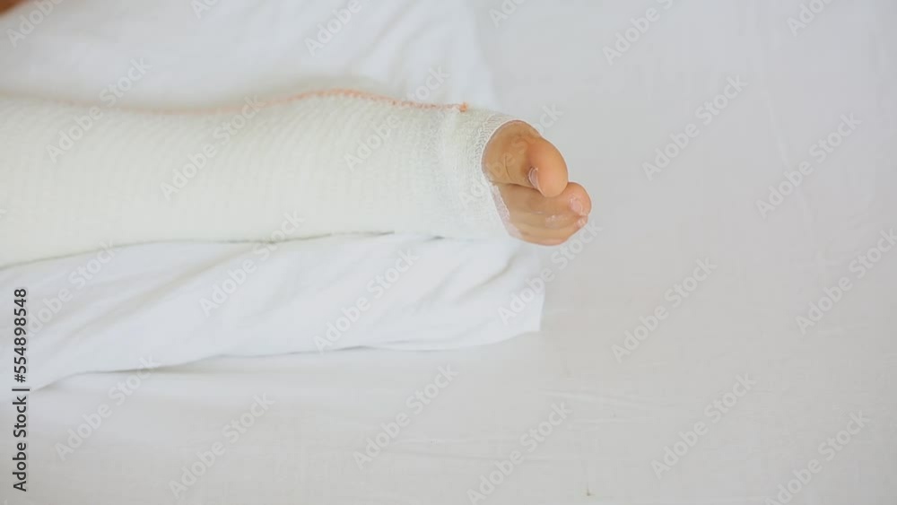 Children's broken leg in orthopedic cast on a white bed in the . Broken ...