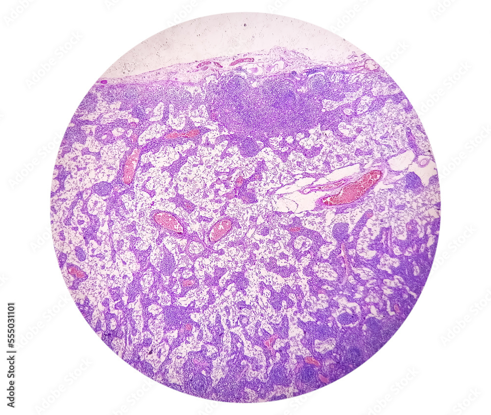 Photomicrograph of Stomach Adenocarcinoma. Gastric Adenocarcinoma ...