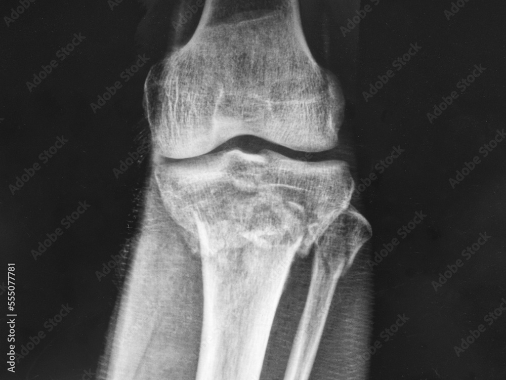 X-ray image of tibial plateau fracture and fibular head fracture Stock ...