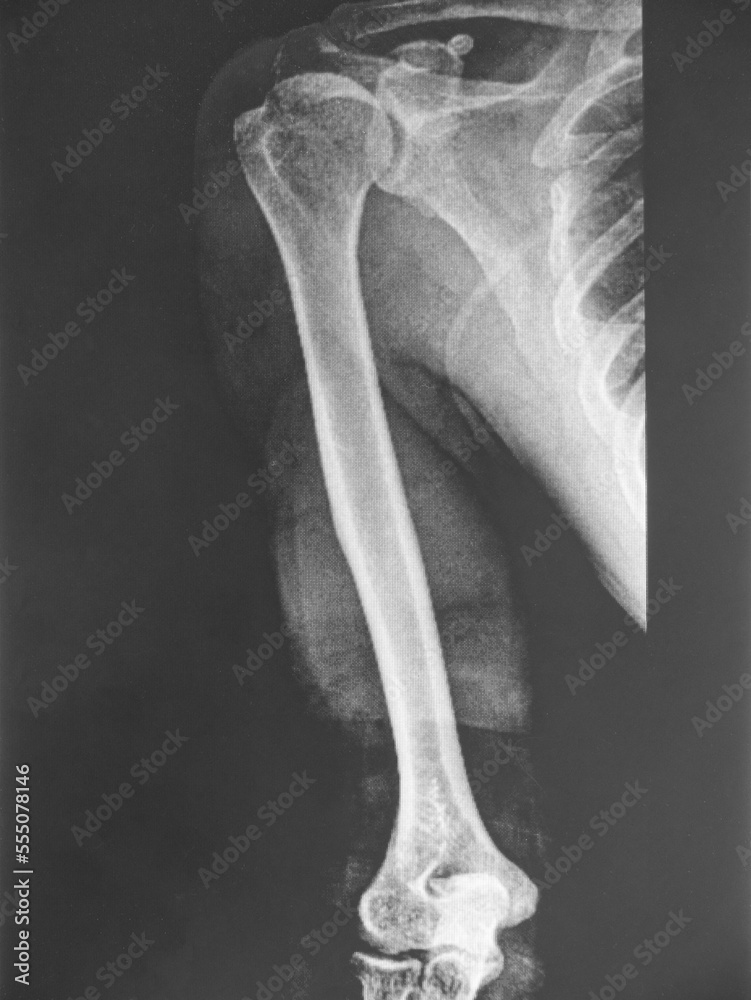 X-ray image of human humerus Stock Photo | Adobe Stock