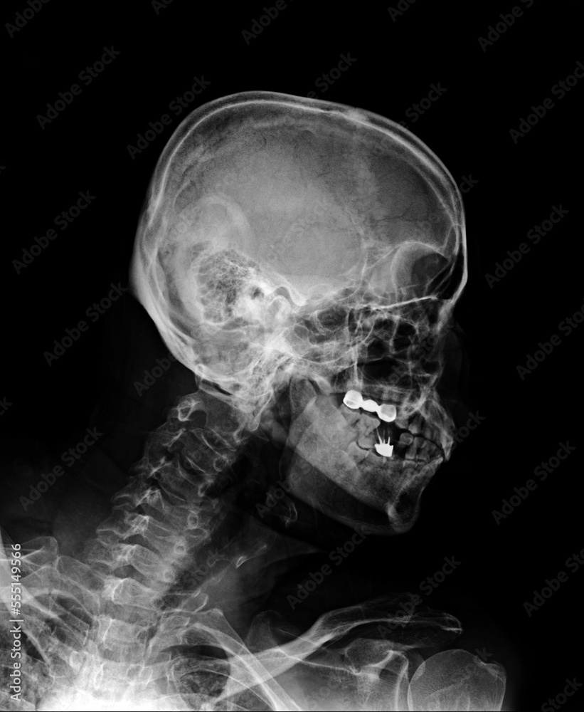X-ray Lateral view skull and cervical spine . AP skull and cervical ...