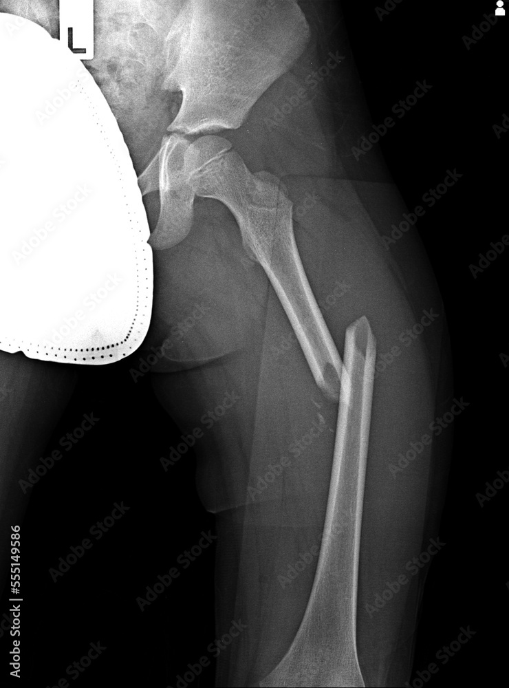 X-ray Left femur show complete fracture shaft of femur Stock Photo ...