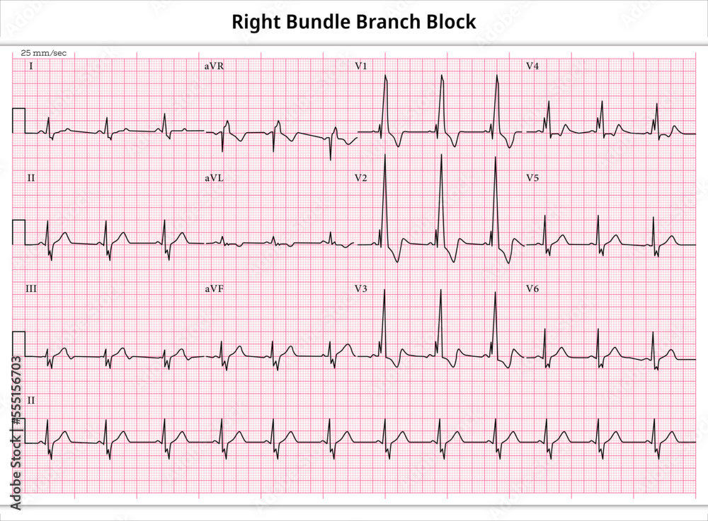 Stockvector ECG RBBB (Right Bundle Branch Block) - 12 Leads ECG Paper ... Stockvector ECG RBBB (Right Bundle Branch Block) - 12 Leads ECG Paper ...