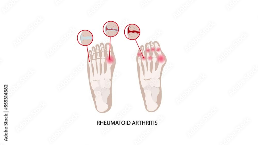 RHEUMATOID DISEASE LEG VIDEO Diagram Of Rheumatic Arthritis Chronic ...