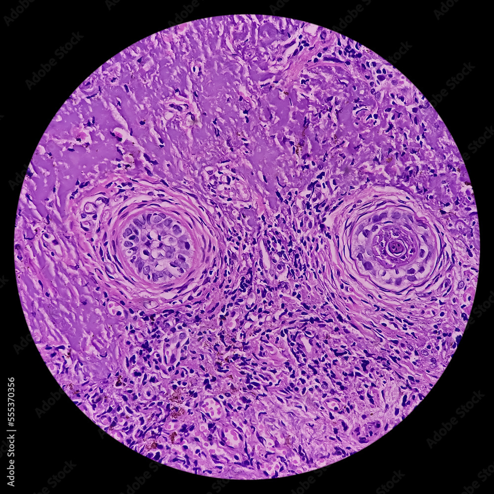 Basal cell carcinoma, show skin, malignant neoplasm of atypical ...