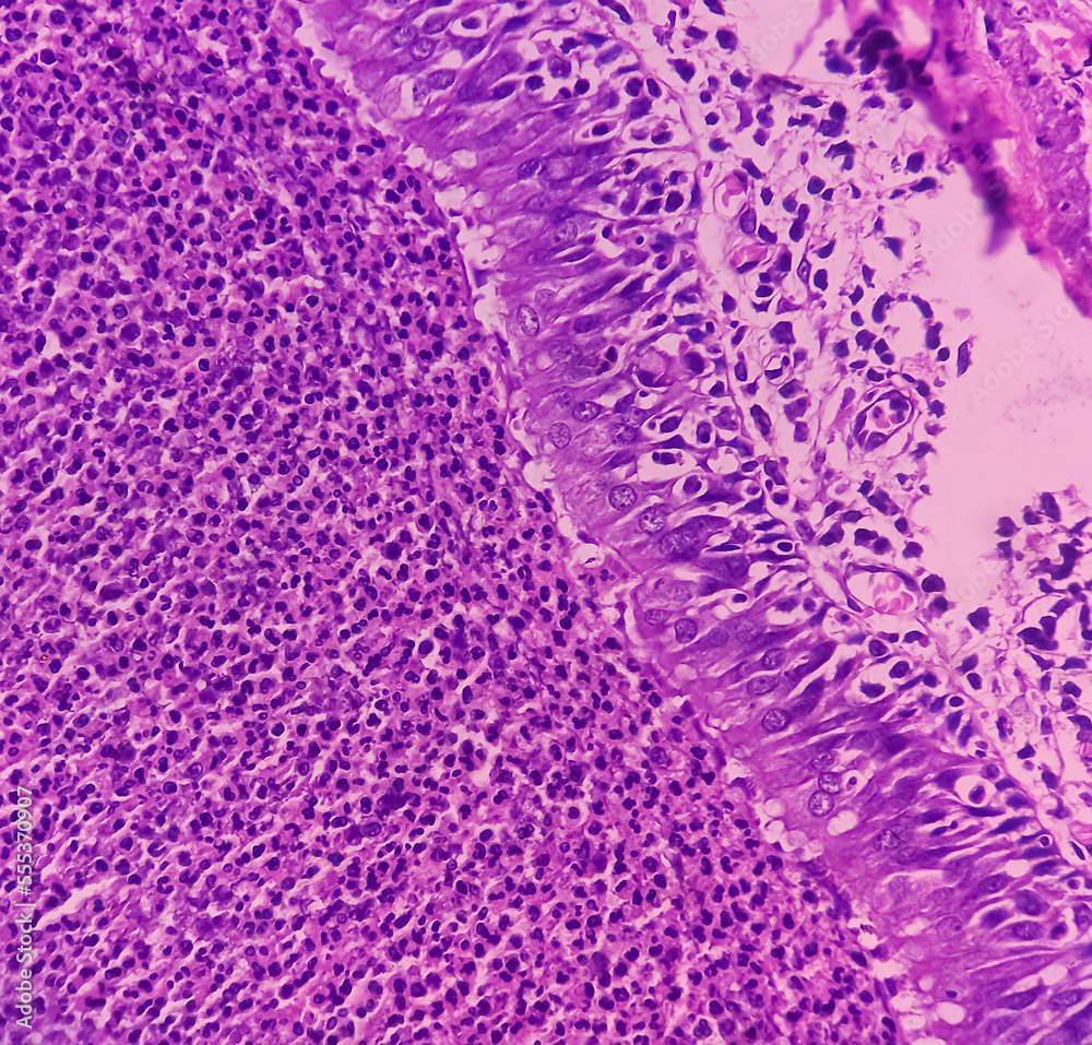 Cheek Cystbiopsy Microscopic View Of Mucous Retention Cyst Benign Pathologic Lesion Stock