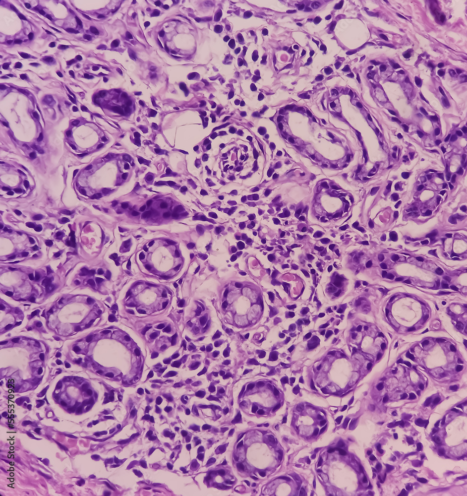 Cheek cyst(biopsy): Microscopic view of Mucous retention cyst, benign ...