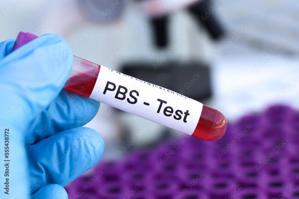 PBS test to look for abnormalities from blood Stock Photo | Adobe Stock