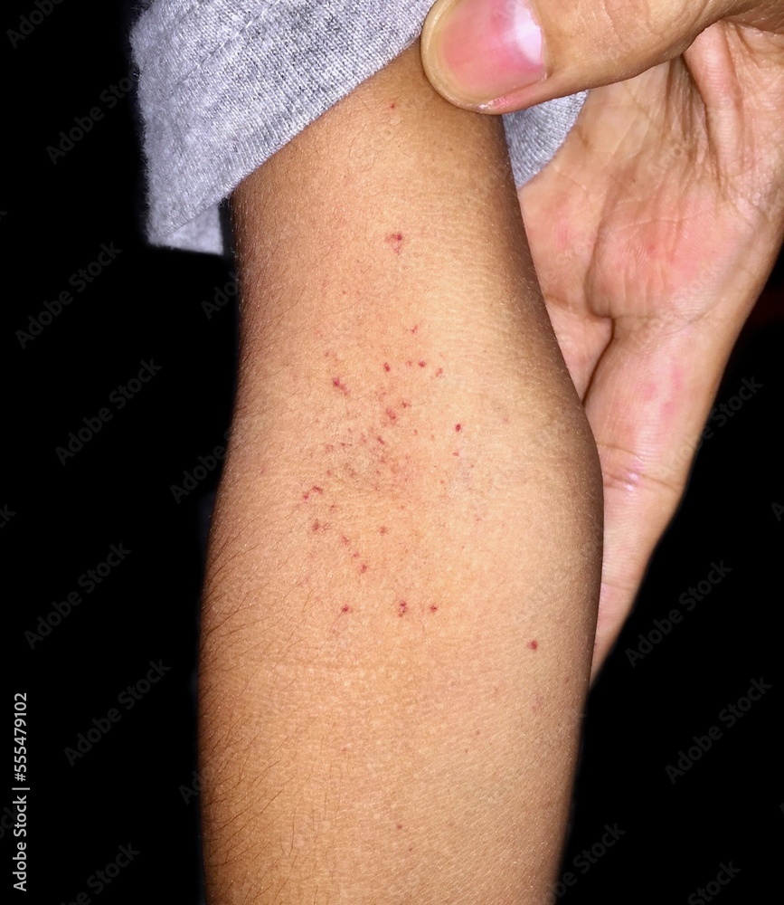 Red spots in cubital fossa. Hess’s test positive. Dengue hemorrhagic ...