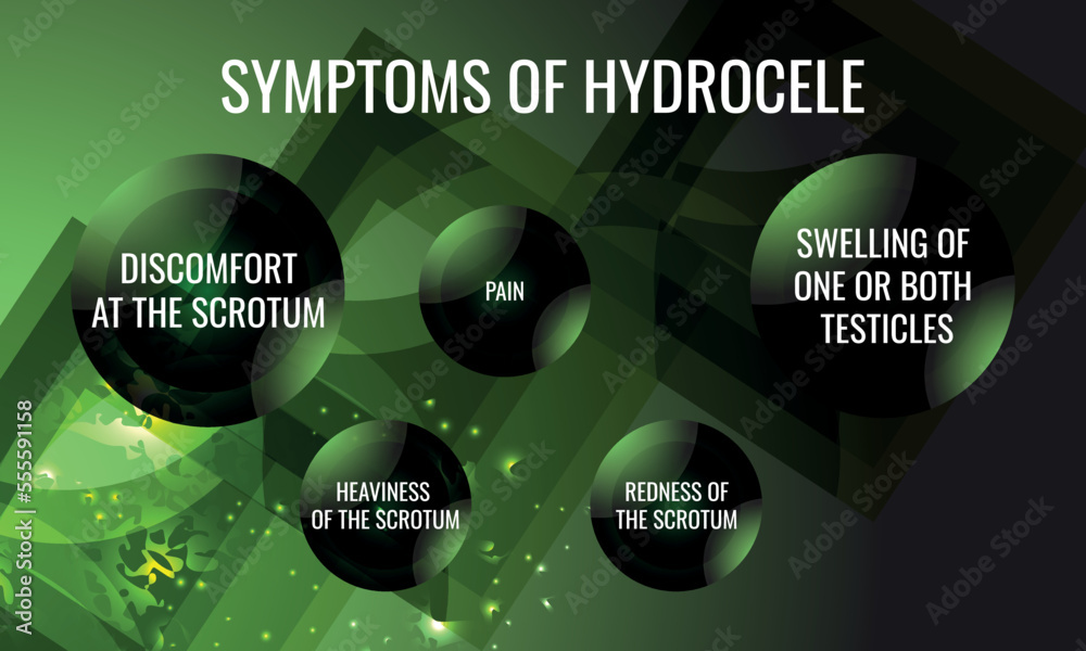symptoms of Hydrocele. Vector illustration for medical journal or ...