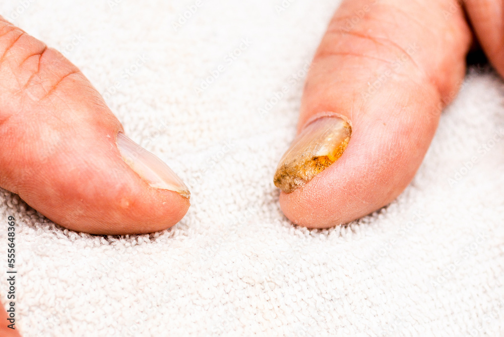 Fotka „Fungal infection on nail hand,finger with onychomycosis,damage ...