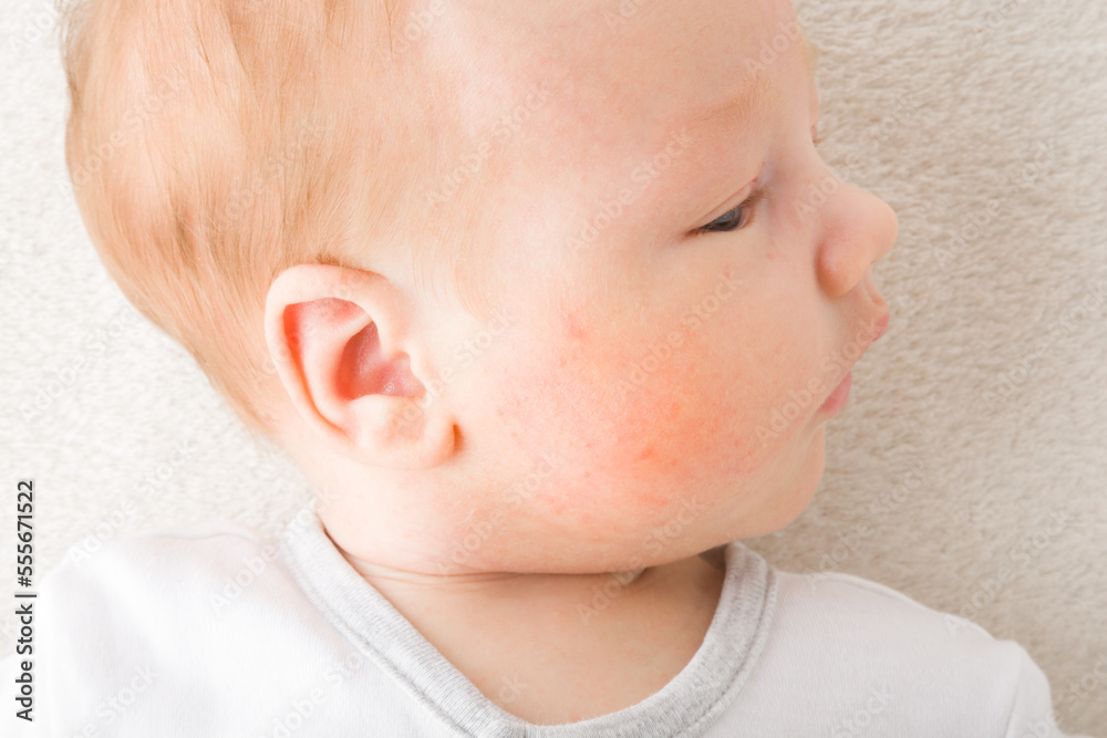 Newborn boy cheek with red rash. Allergy from milk formula or mother ...