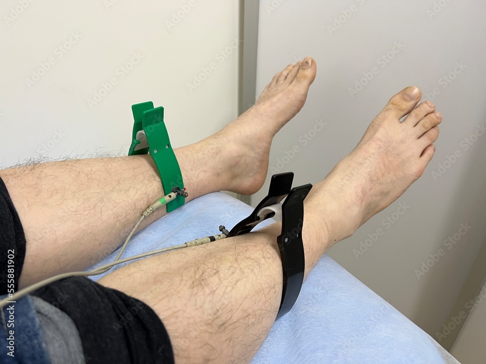 Electrode of ECG tracing of ill patient in the intensive care unit ECG ...