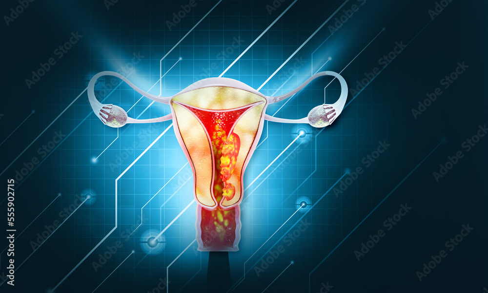 Female reproductive system diseases. Uterus cancer and endometrial ...
