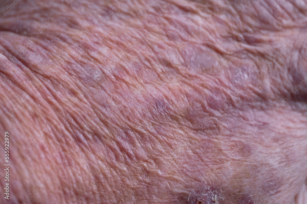 Lesions of actinic keratosis or sunspots on sun-damaged skin of the ...