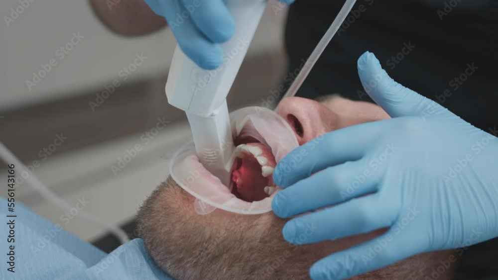 Close up: Doctor scans the teeth of a male patient in the medical ...