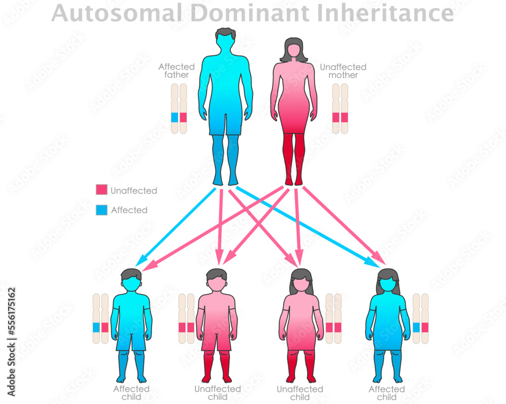 Autosomal dominant inheritance. Affected father, unaffected mother child, son, doughter. Red ...