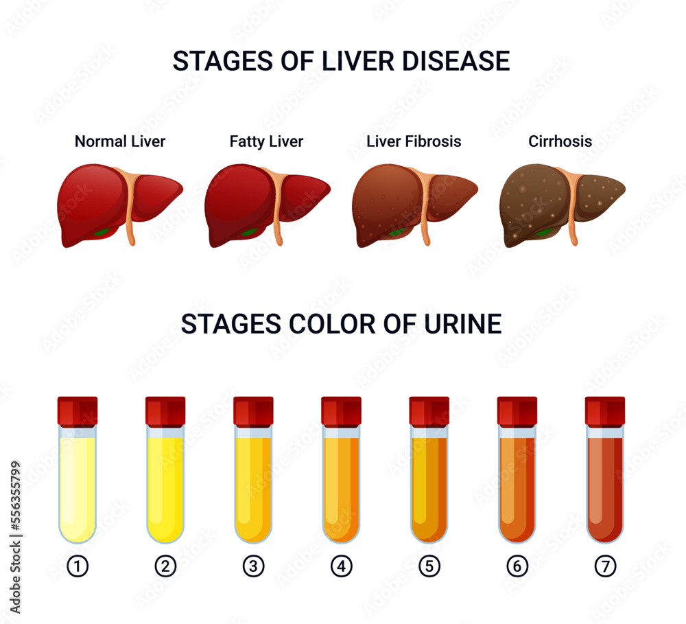 Stages of liver disease, design vector for medical illustration Stock ...