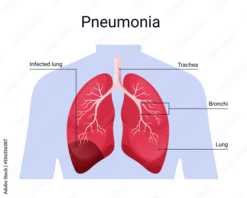 Structure diagram of Pneumonia disease Stock Vector | Adobe Stock