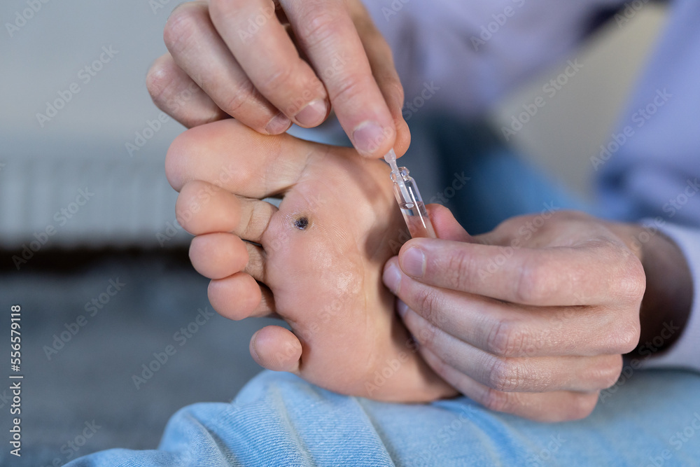 Alternative home treatment of verruca foot. Man applying liquid ...