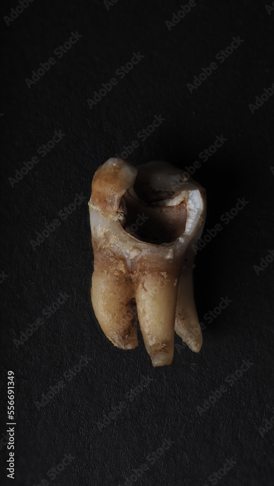 Tooth decay on black background. Macro shot of a decayed teeth till ...