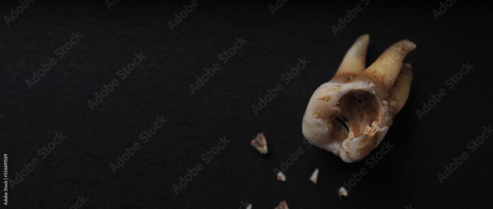 Tooth decay on black background. Macro shot of a decayed teeth till ...
