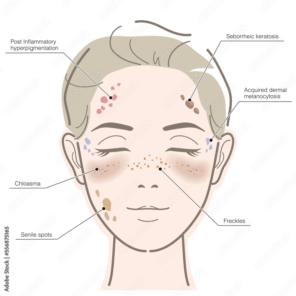 Diagram of women's facial age spots. Vector illustration isolated on ...
