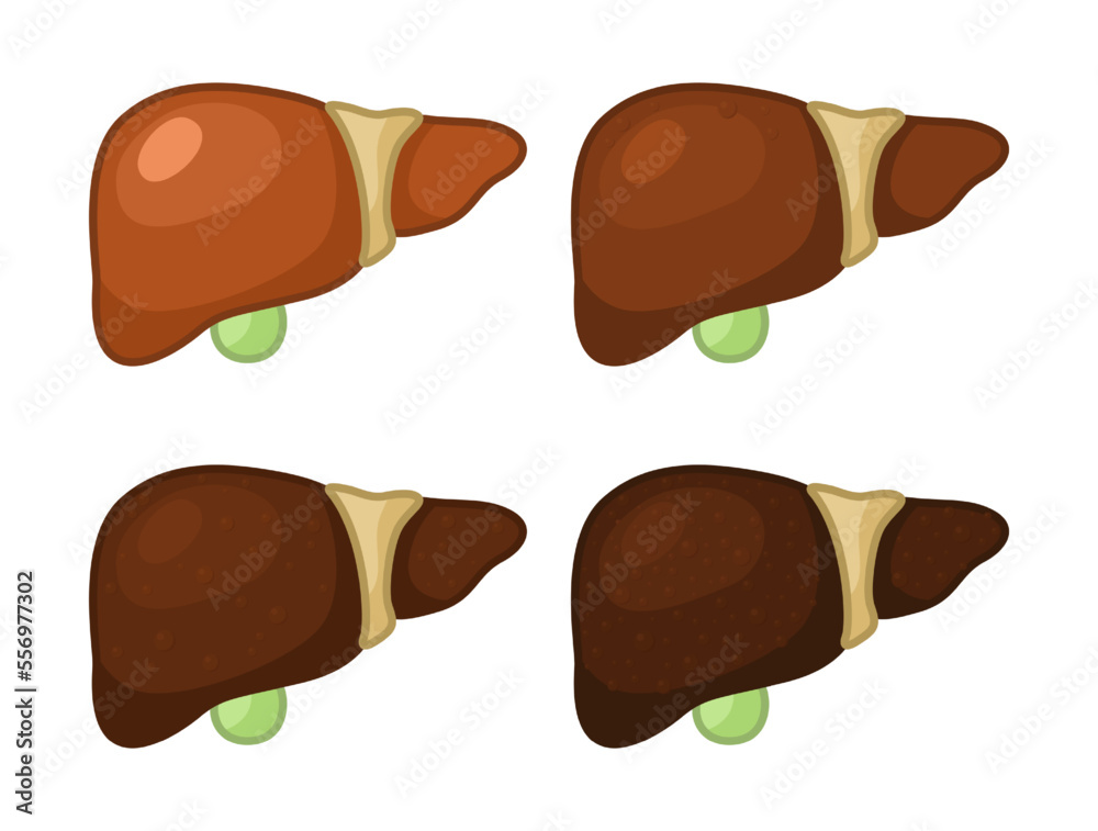 Stages of liver damage or disease vector illustrations set. Drawings of ...