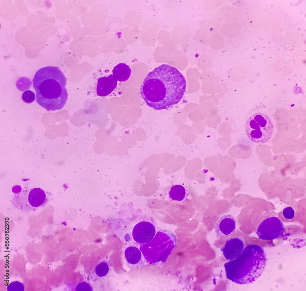 Bone marrow study. Plasma cell dyscrasia or Multiple myeloma. Present ...