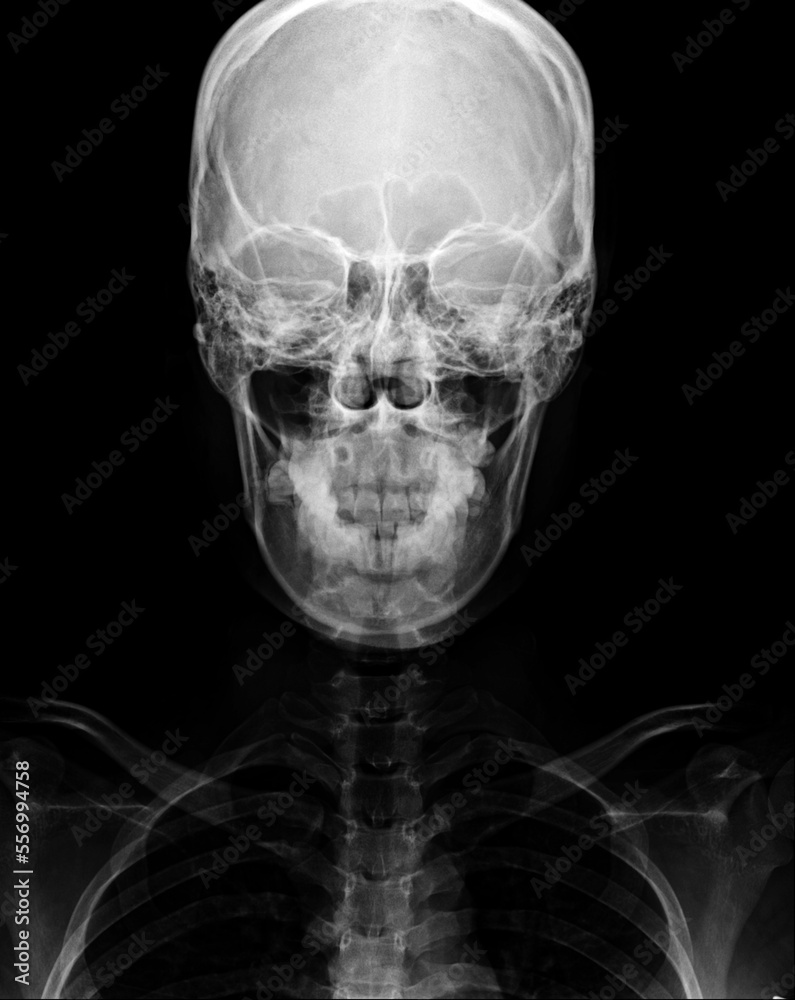 Photo & Art Print Film x-ray of normal human skull . front view ., Nut