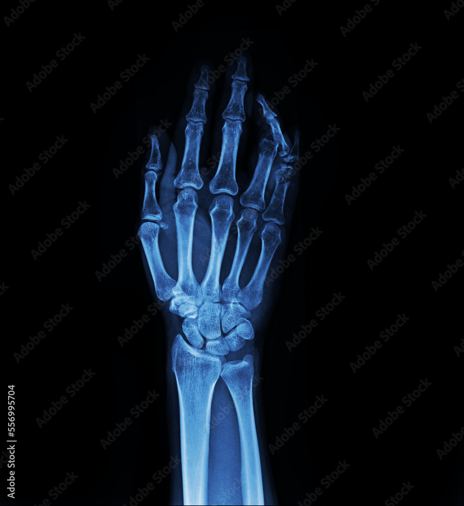 Film x-ray fracture ring finger and Fracture little finger . Film x-ray ...