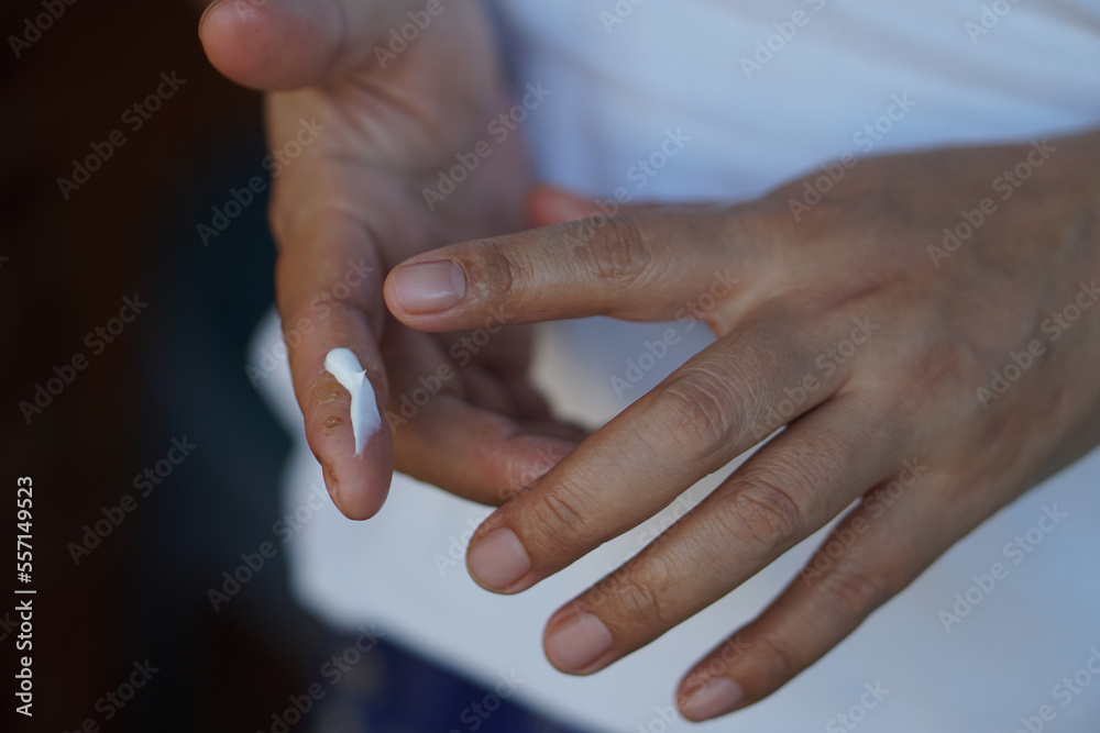 Foto de Closeup hand applying medicinal cream on infectious fingers ...