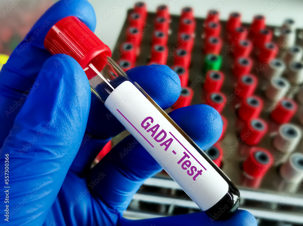 Blood sample for Glutamic acid decarboxylase antibody (GADA) test ...