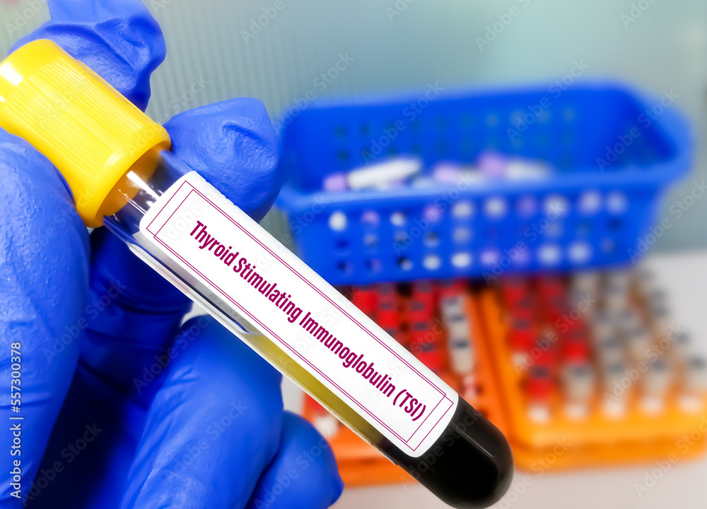 Blood sample for Thyroid stimulating Immunoglobulin test. Throtropin ...