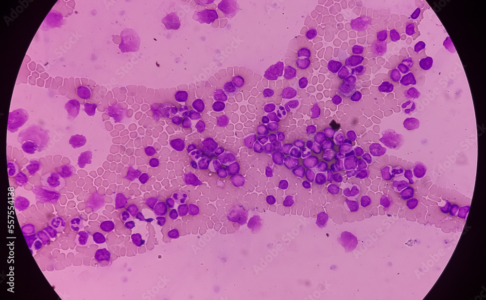 Acute leukemia (Probably ALL). Anisocytic anisochromia, increased ...