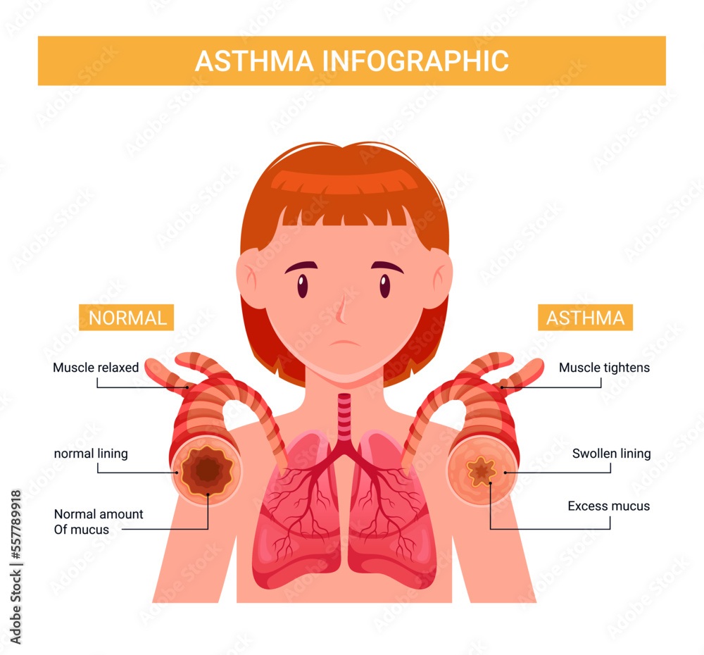Asthma infographic, concept human asthma, healthy and unhealthy lung ...