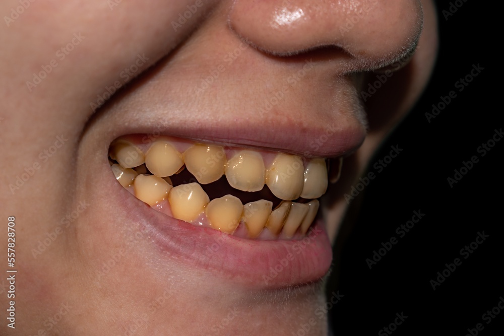 Small teeth with yellow colored tobacco stains. Poor oral hygiene ...