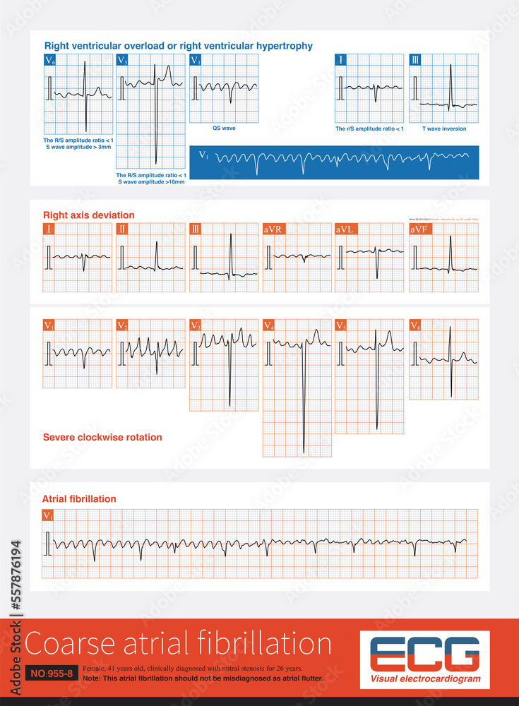 Mitral stenosis is a common valvular heart disease, the disease ...
