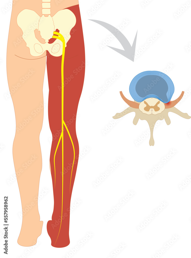 Sciatica - sciatic nerve Pain illustration in the right leg Stock ...