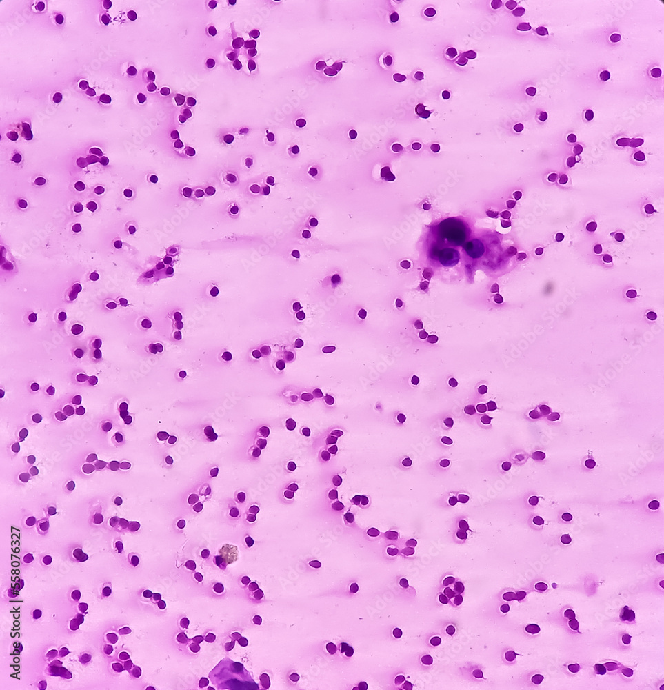 Thyroid nodule (FNA cytology): Cellular follicular lesion, microscopic ...