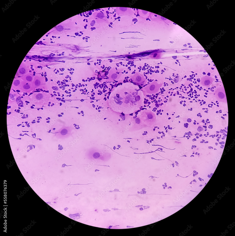 Fotografia do Stock: Pap's smear. Reactive cellular changes associated ...