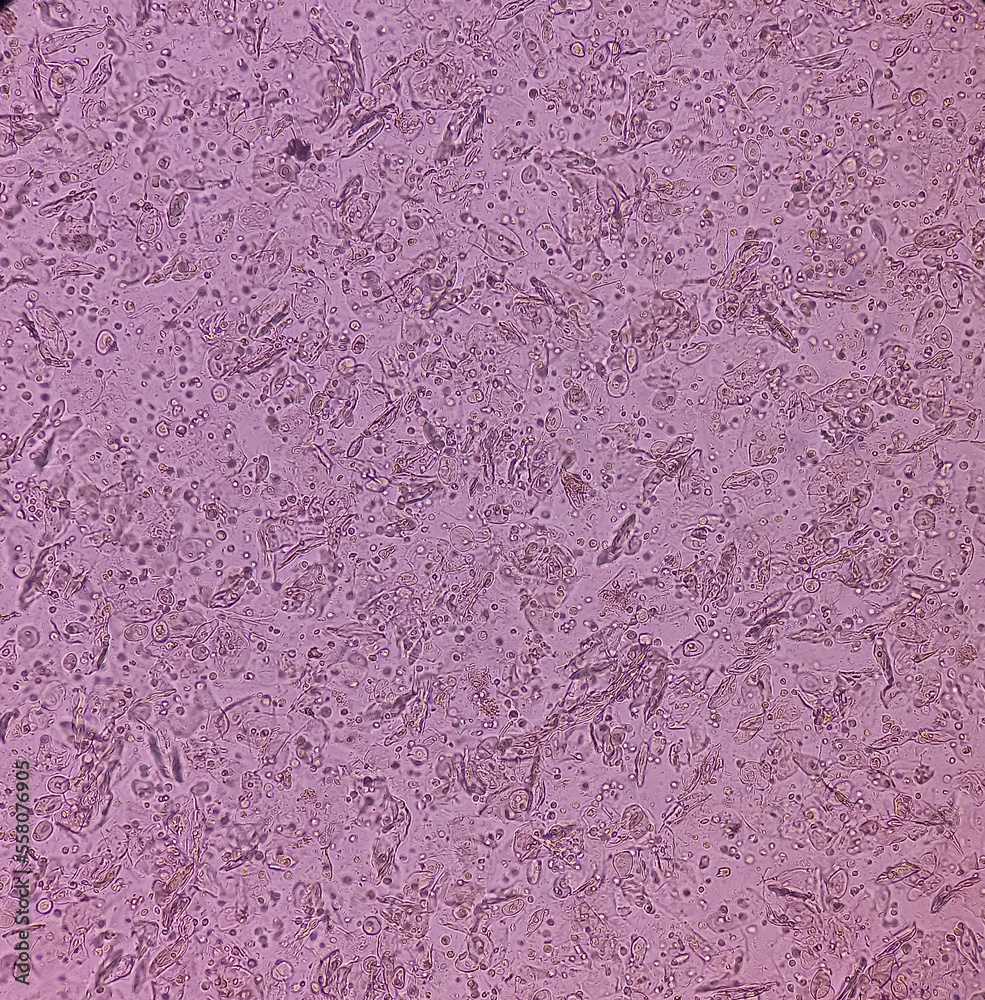 Photomicrograph close view of Abnormal urine analysis under light ...