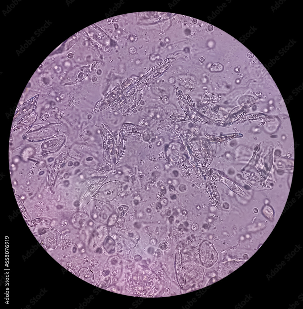 Photomicrograph close view of Abnormal urine analysis under light ...