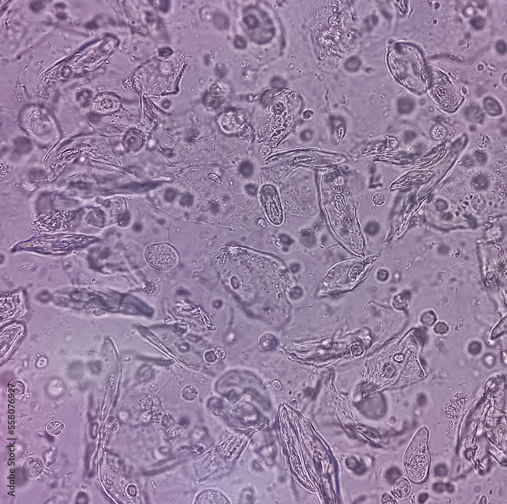 Photomicrograph Close View Of Abnormal Urine Analysis Under Light Microscope Epithelial Cell