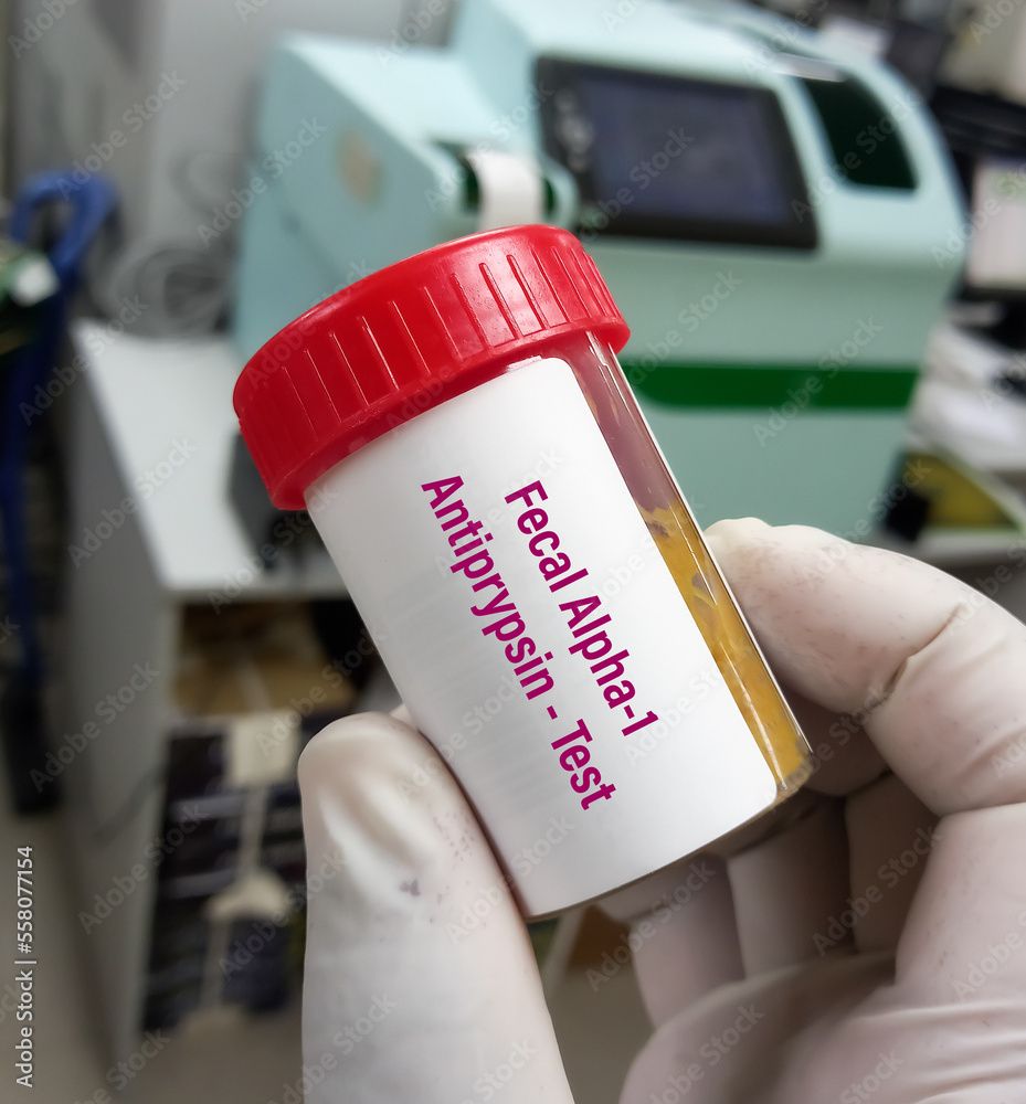 Foto Stock Scientist holds feces sample for fecal alpha 1 antitrypsin ...