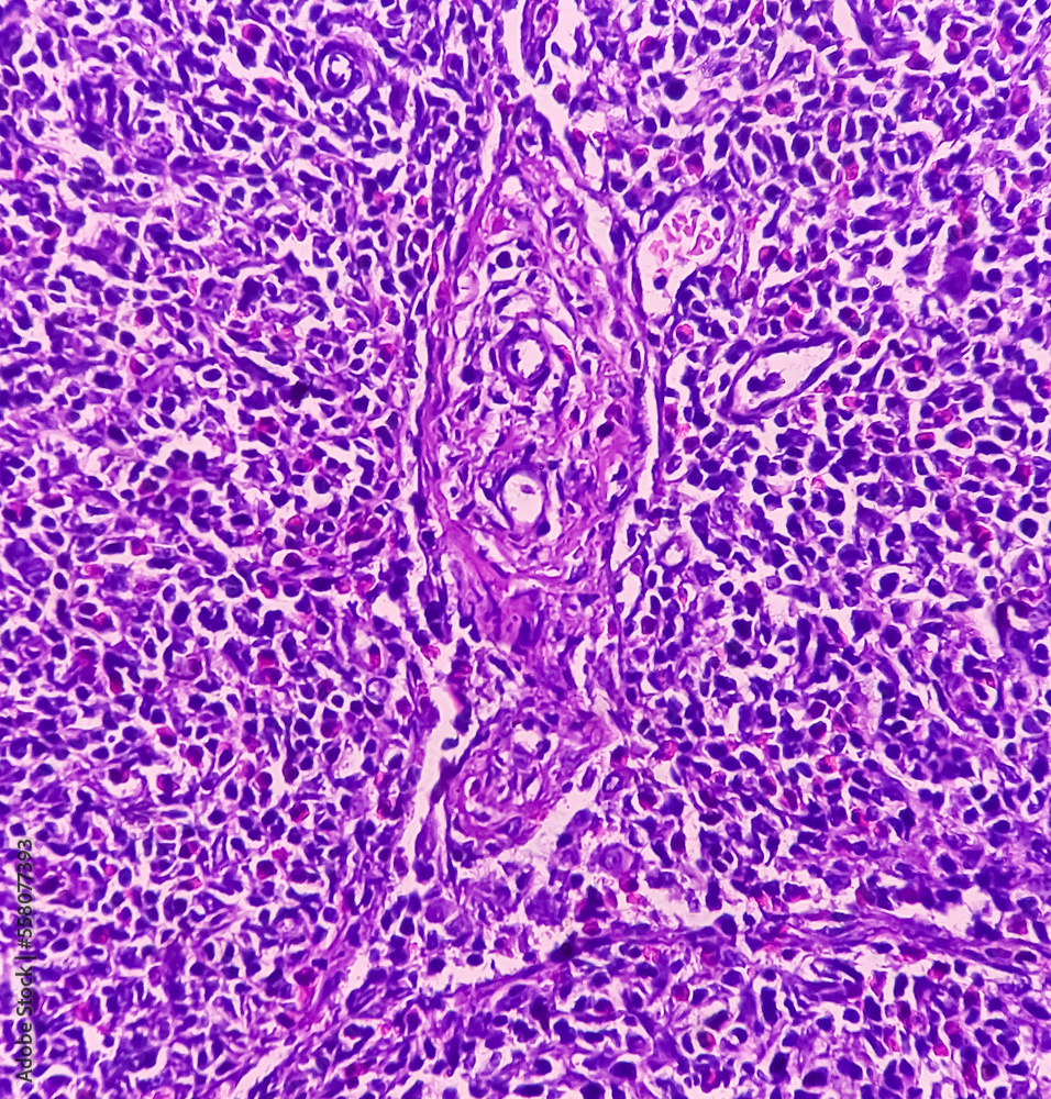 Lymph node (biopsy): Hodgkin's lymphoma, mixed cellularity, monotonous ...