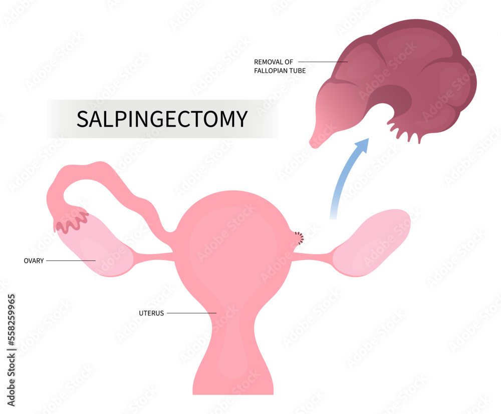 Pelvic cancer tumor disease anatomy uterus pain surgical biopsy hormone ...